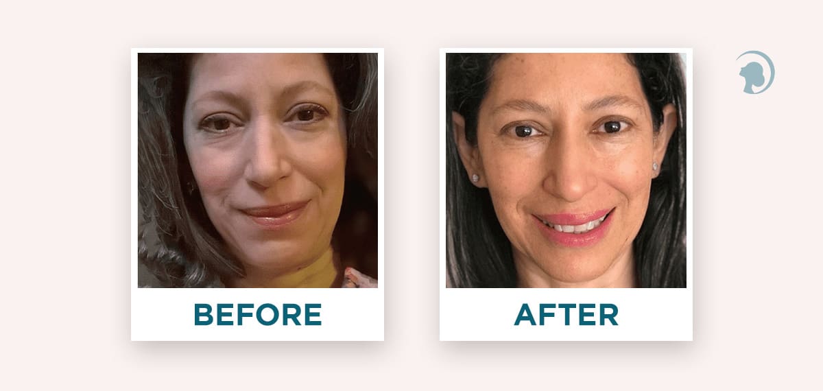 10 Astonishing Before And After Face Yoga Transformations