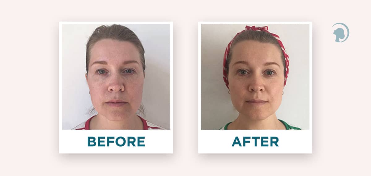10 Astonishing Before And After Face Yoga Transformations