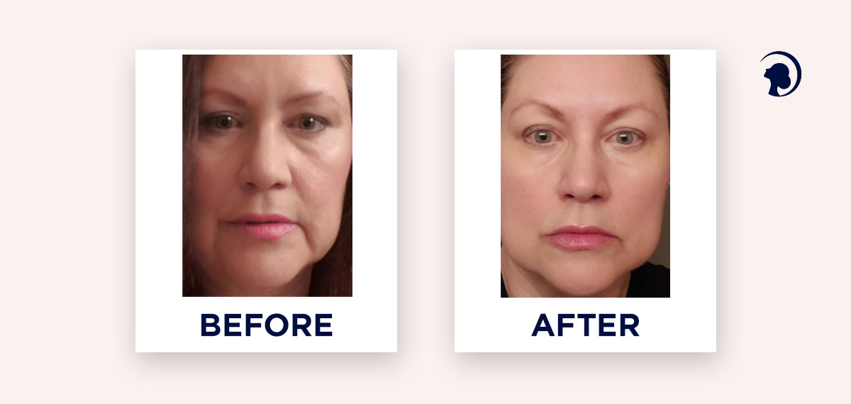 How To Get Rid Of Sagging Jowls In Less Than A Month